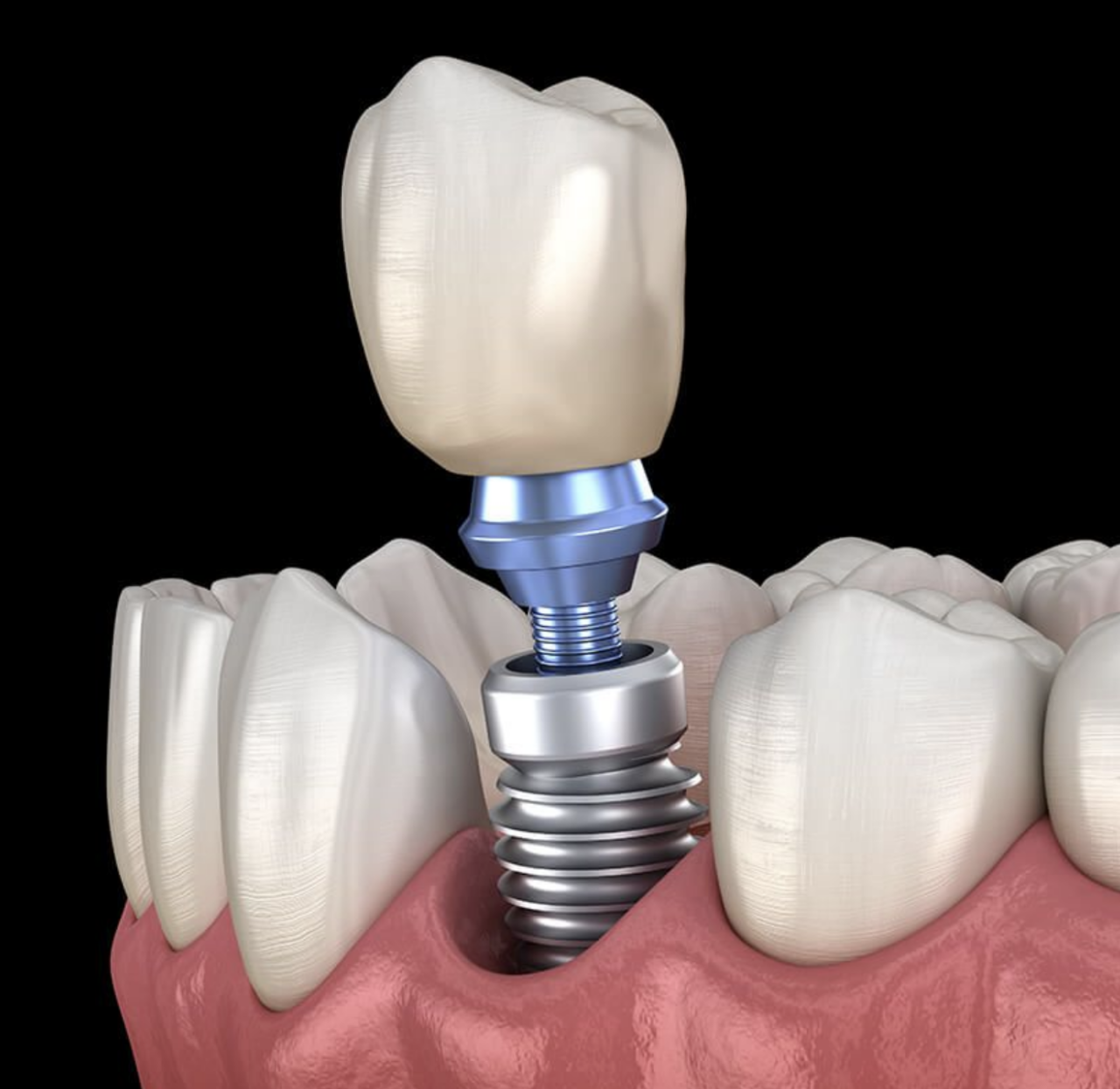 Implantes | Odontología Integral